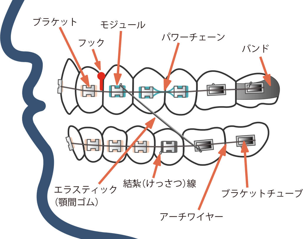 外側ワイヤー矯正 ・マルチブラケット法 | Smile@立川おとなとこどもの矯正歯科